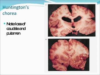 huntington chorea for nursing | PPT