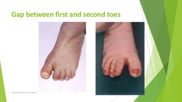 Genetic abnormalities by Aamir khan pameer