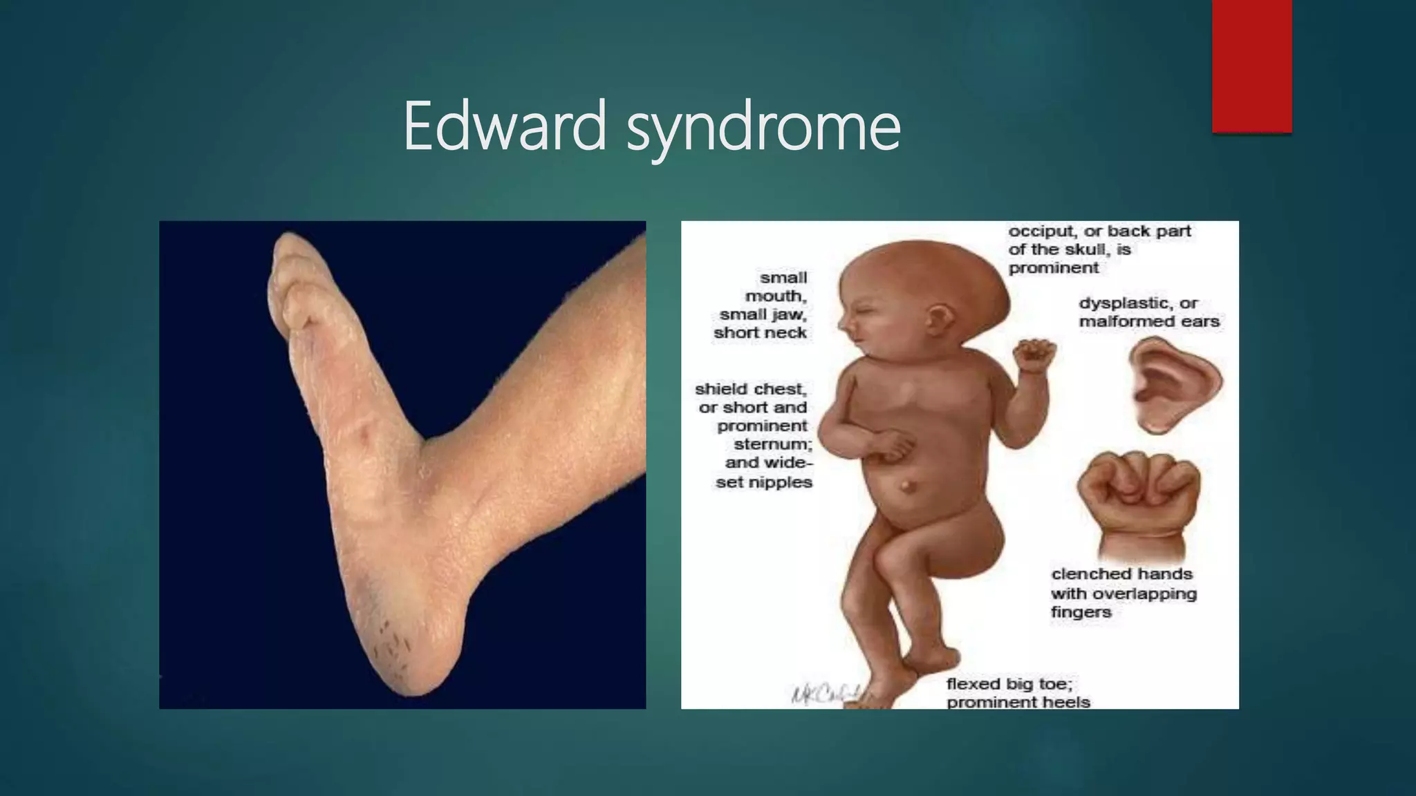 Genetic disorder and Chromosomal abnormalities | PPTX