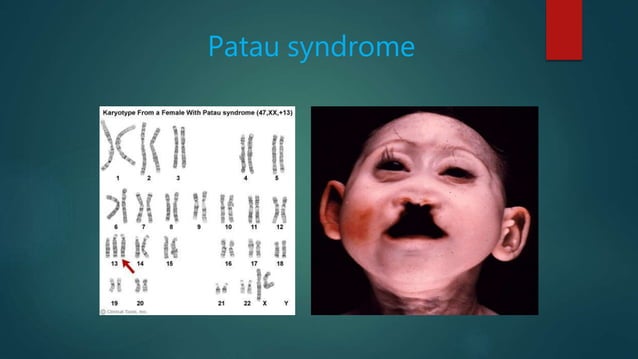 Genetic disorder and Chromosomal abnormalities | PPTX