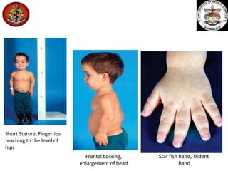 genetic disorders of bone.pptx