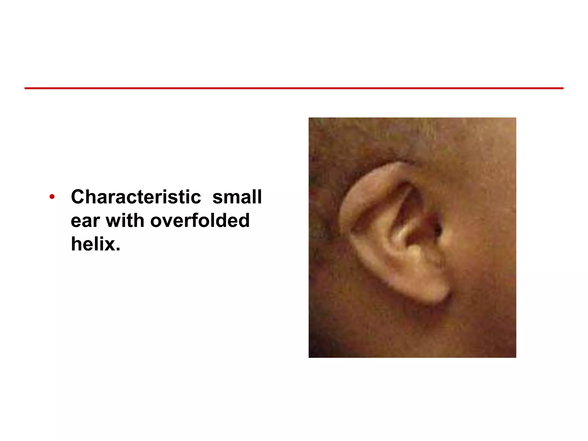 Genetic Disorders.ppt