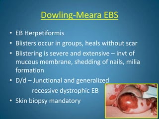 Epidermolysis Bullosa Simplex Dowling Meara