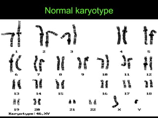 Sickle Cell Anemia Karyotype