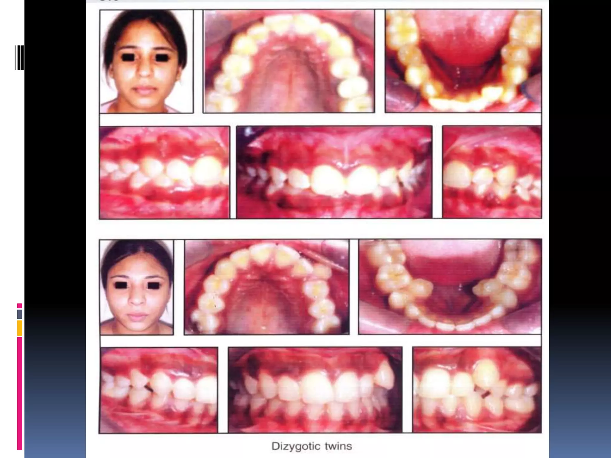 Genetics in orthodontics | PPTX