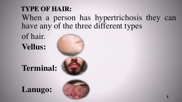 Genetics Of Congenital Generalized Hypertrichosis