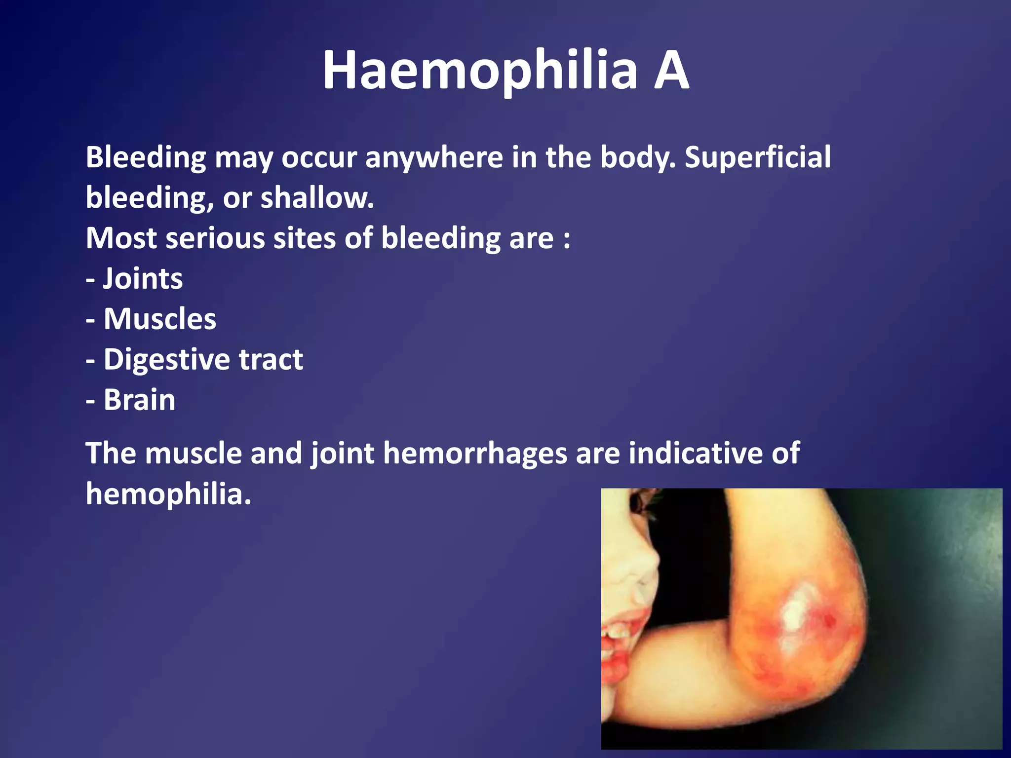 Genetics of hemophilia A | PPTX