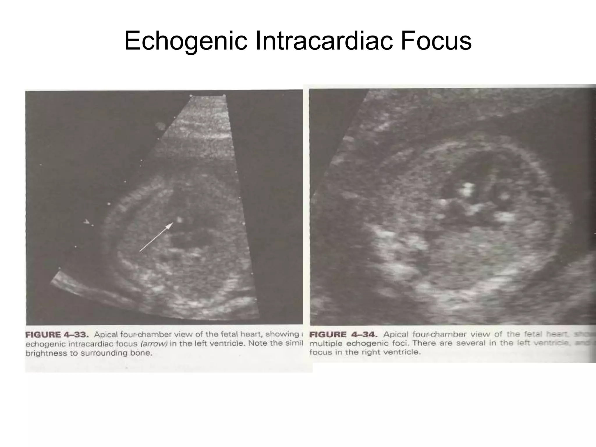 Genetic sonogram and soft tissue markers | PPTX