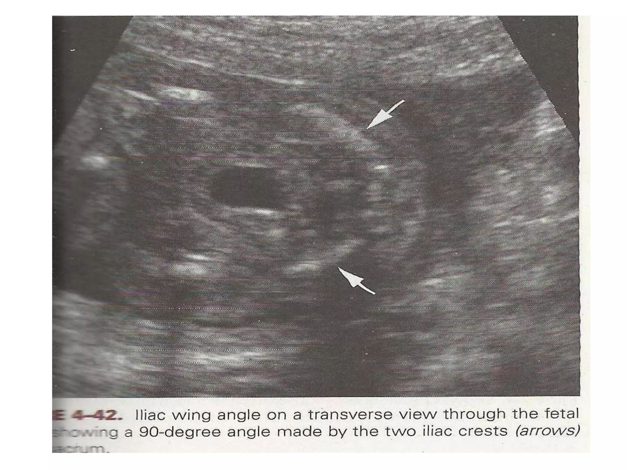 Genetic sonogram and soft tissue markers | PPTX