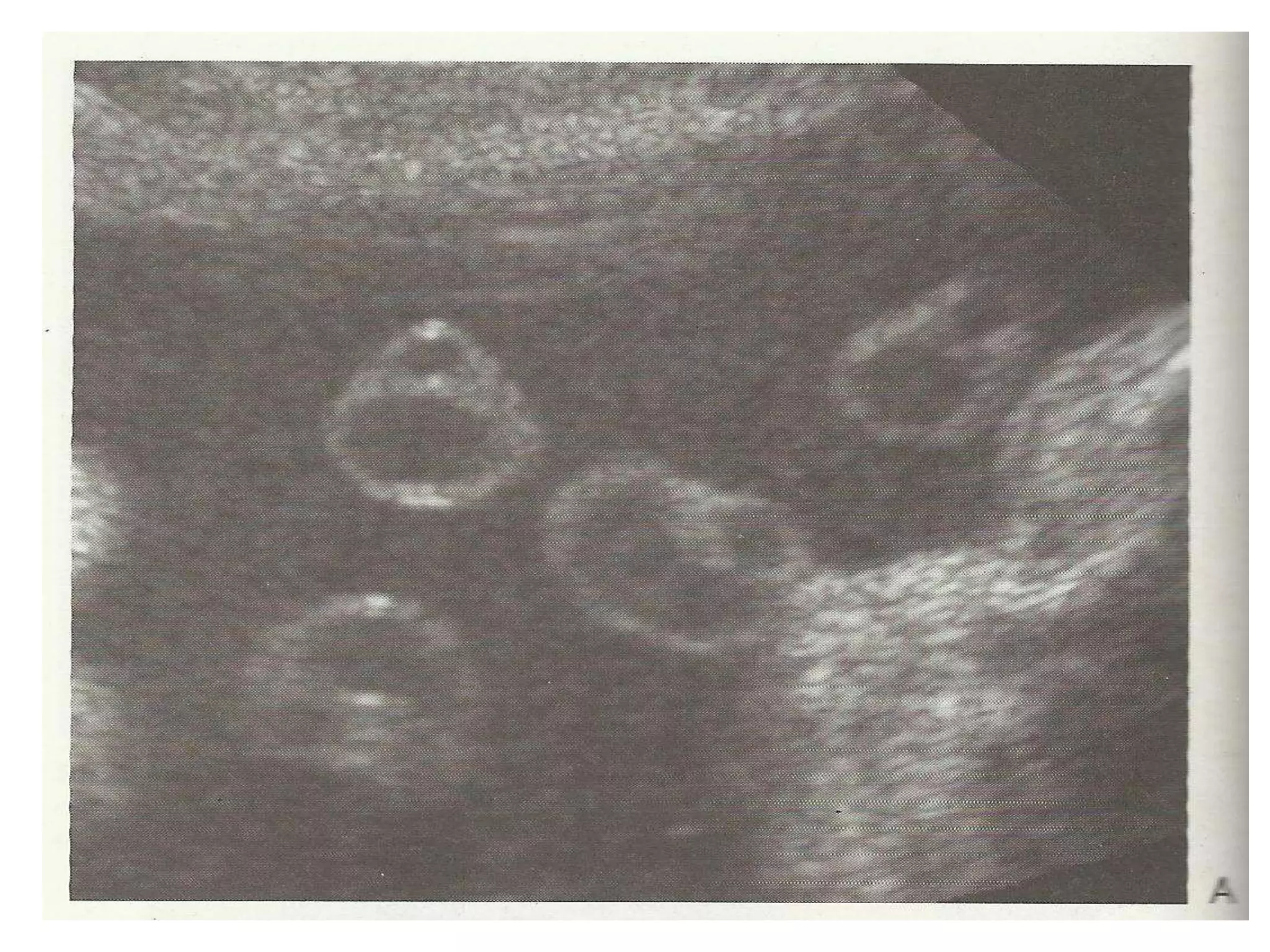 Genetic sonogram and soft tissue markers | PPTX