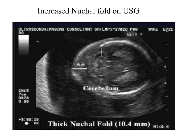 Genetic sonogram and soft tissue markers | PPTX | Pregnancy ...
