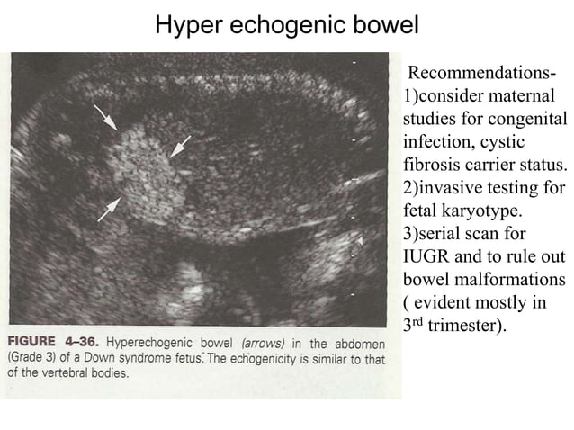 Genetic sonogram and soft tissue markers | PPTX | Pregnancy ...