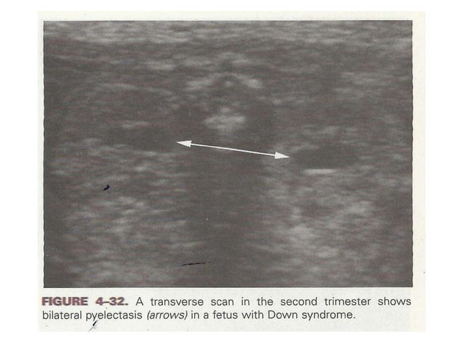 Genetic sonogram and soft tissue markers | PPTX | Pregnancy ...