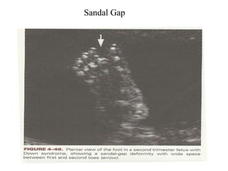 Down Syndrome Ultrasound Markers