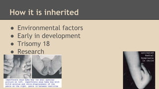 Vacterl Syndrome | PPTX