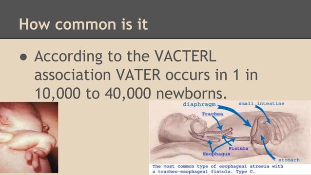 Vacterl Syndrome