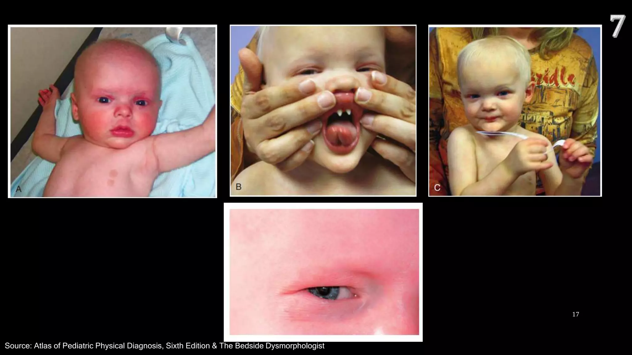 Pediatric Genetic Syndromes - Spot Diagnosis | PPTX