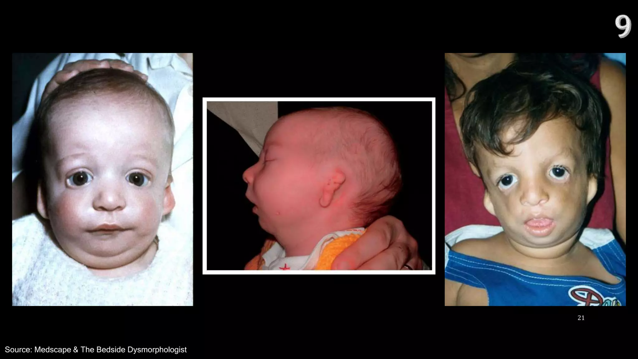 Pediatric Genetic Syndromes - Spot Diagnosis | PPTX