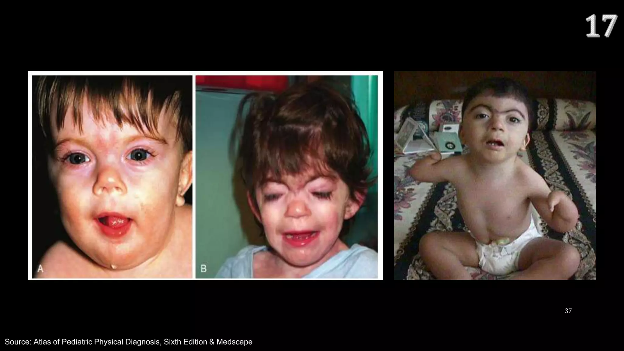 Pediatric Genetic Syndromes - Spot Diagnosis | PPTX