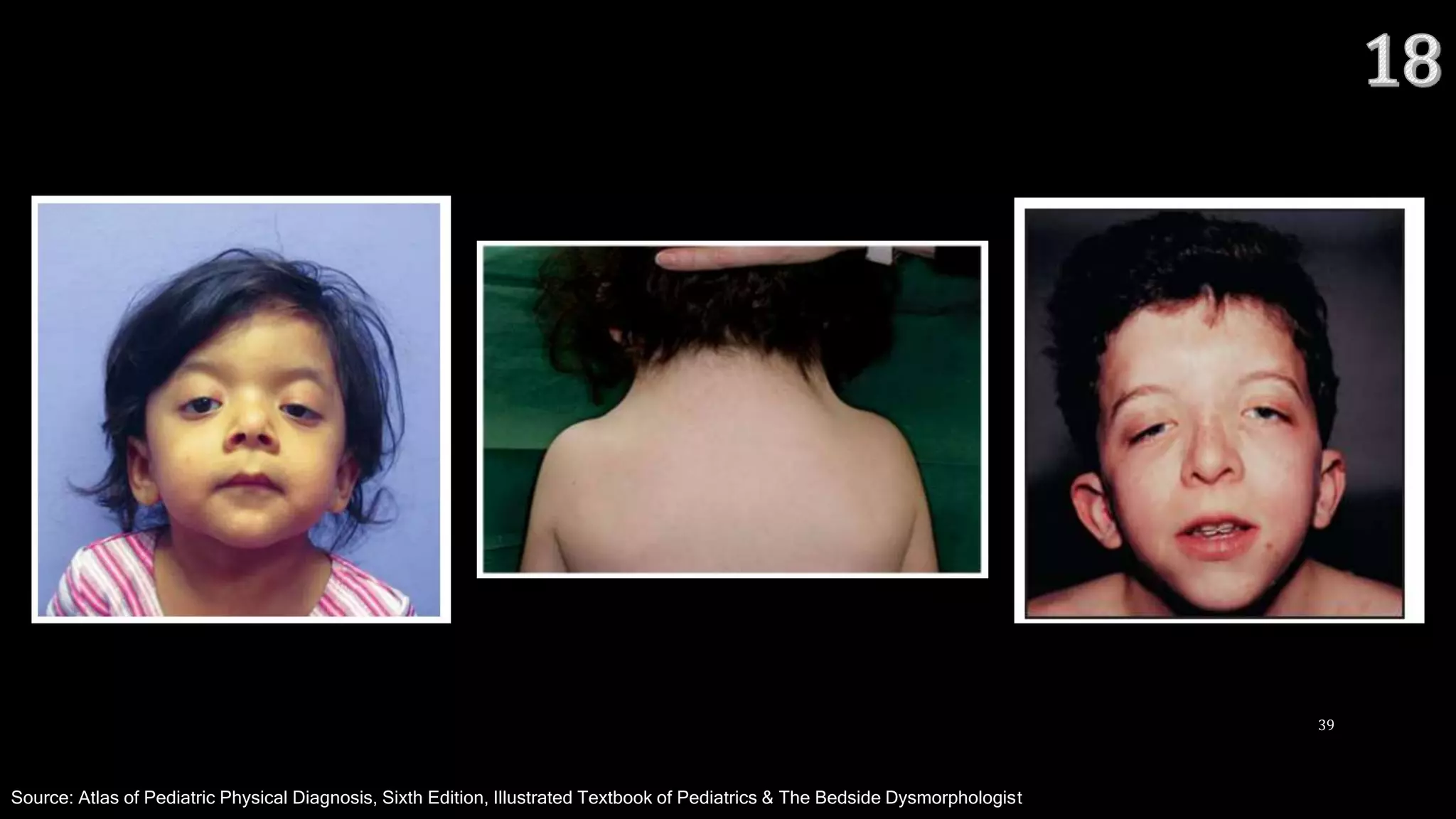 Pediatric Genetic Syndromes - Spot Diagnosis | PPTX