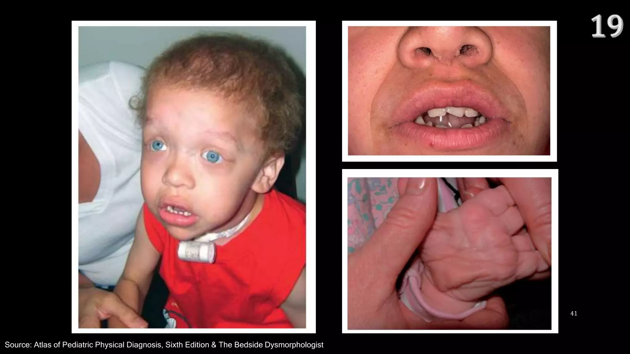 Pediatric Genetic Syndromes - Spot Diagnosis | PPTX