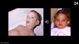 Pediatric Genetic Syndromes - Spot Diagnosis | PPTX