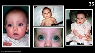 Pediatric Genetic Syndromes - Spot Diagnosis | PPTX