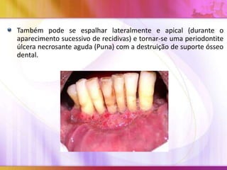 Gengivite ulcerativa necrosante aguda (pronto)(1)(1) | PPTX
