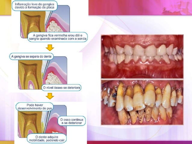 Gengivite ulcerativa necrosante aguda (pronto)(1)(1)