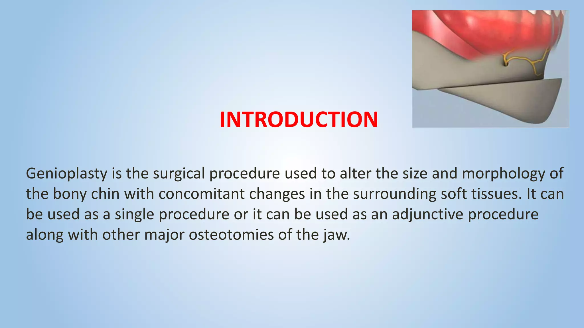 Genioplasty | PPTX