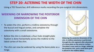 Genioplasty | PPTX