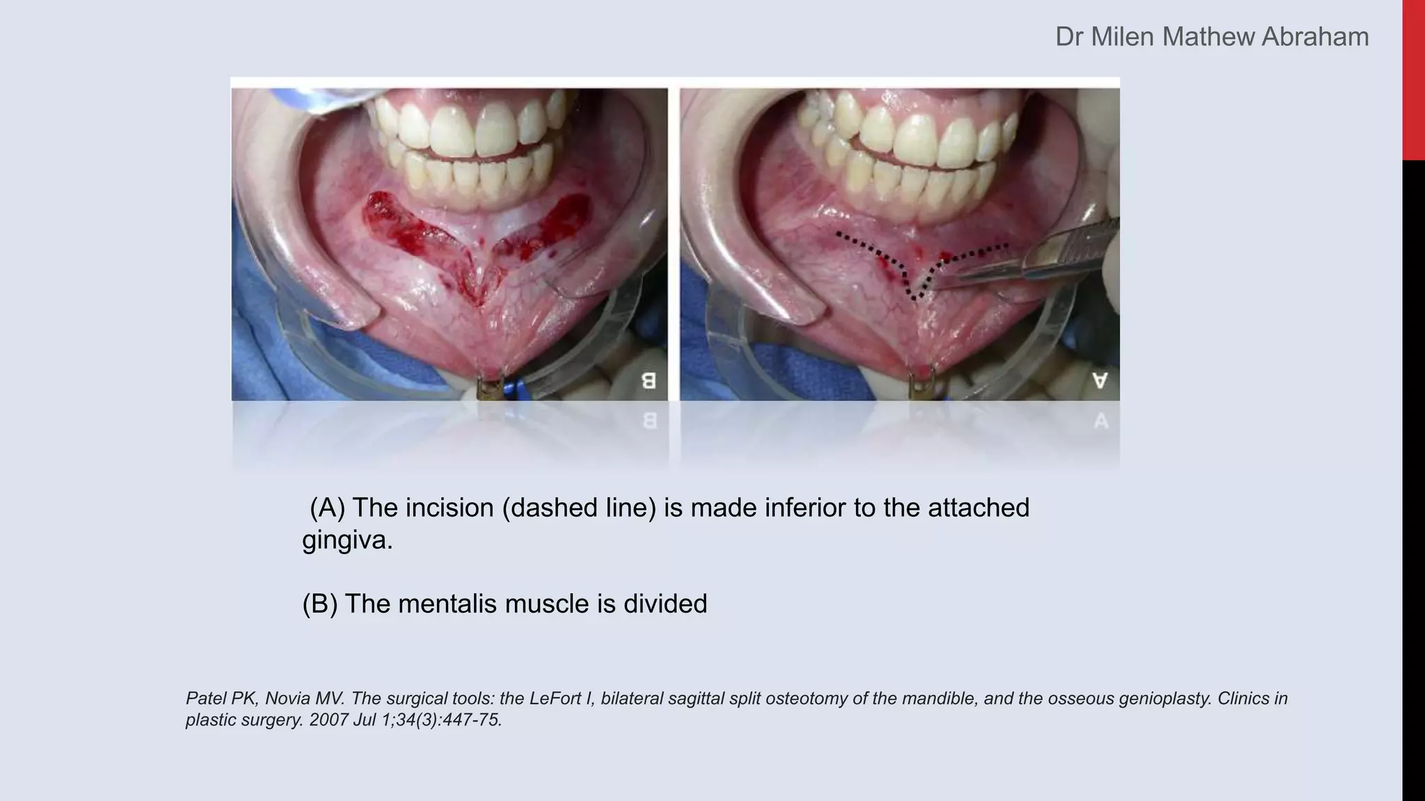 Genioplasty (1) | PPTX