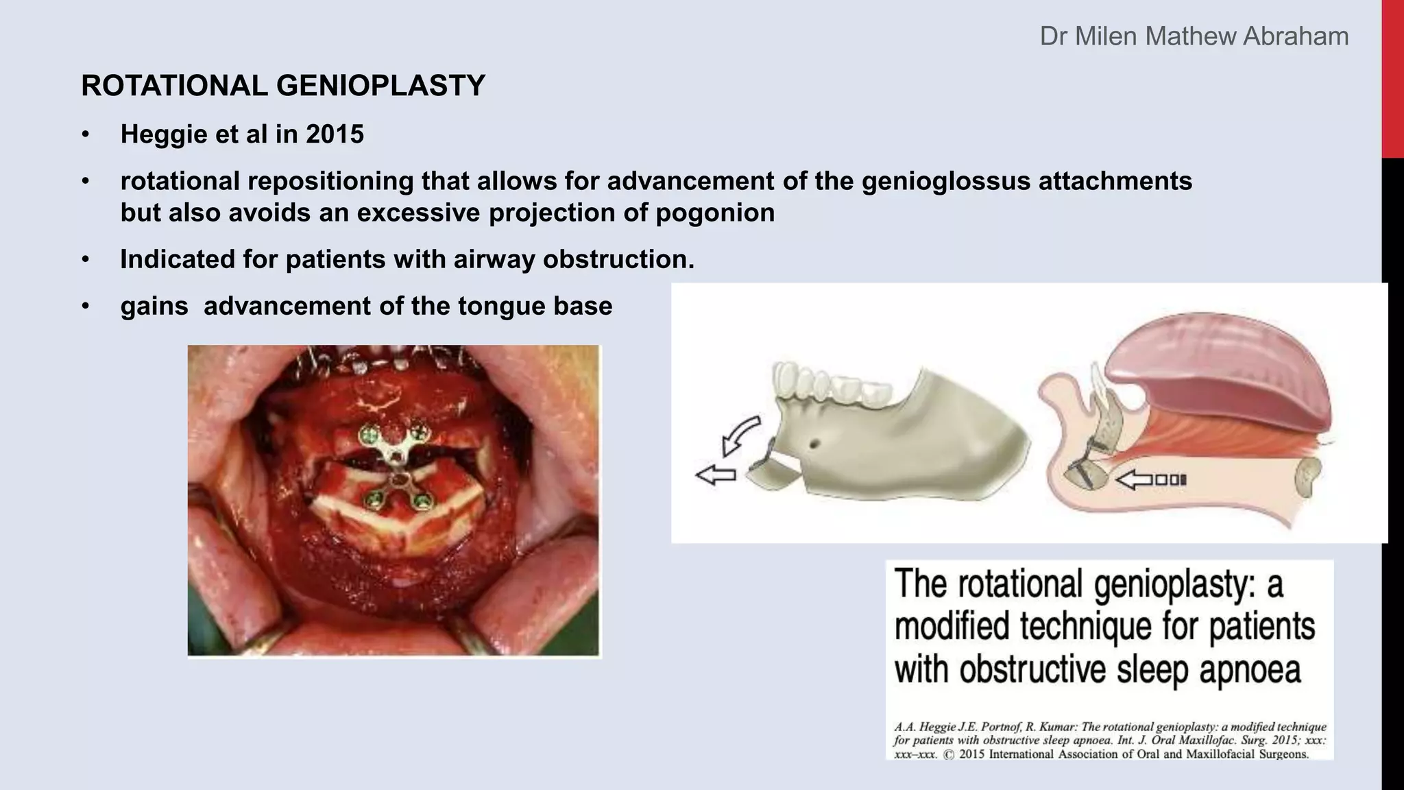 Genioplasty (1) | PPTX