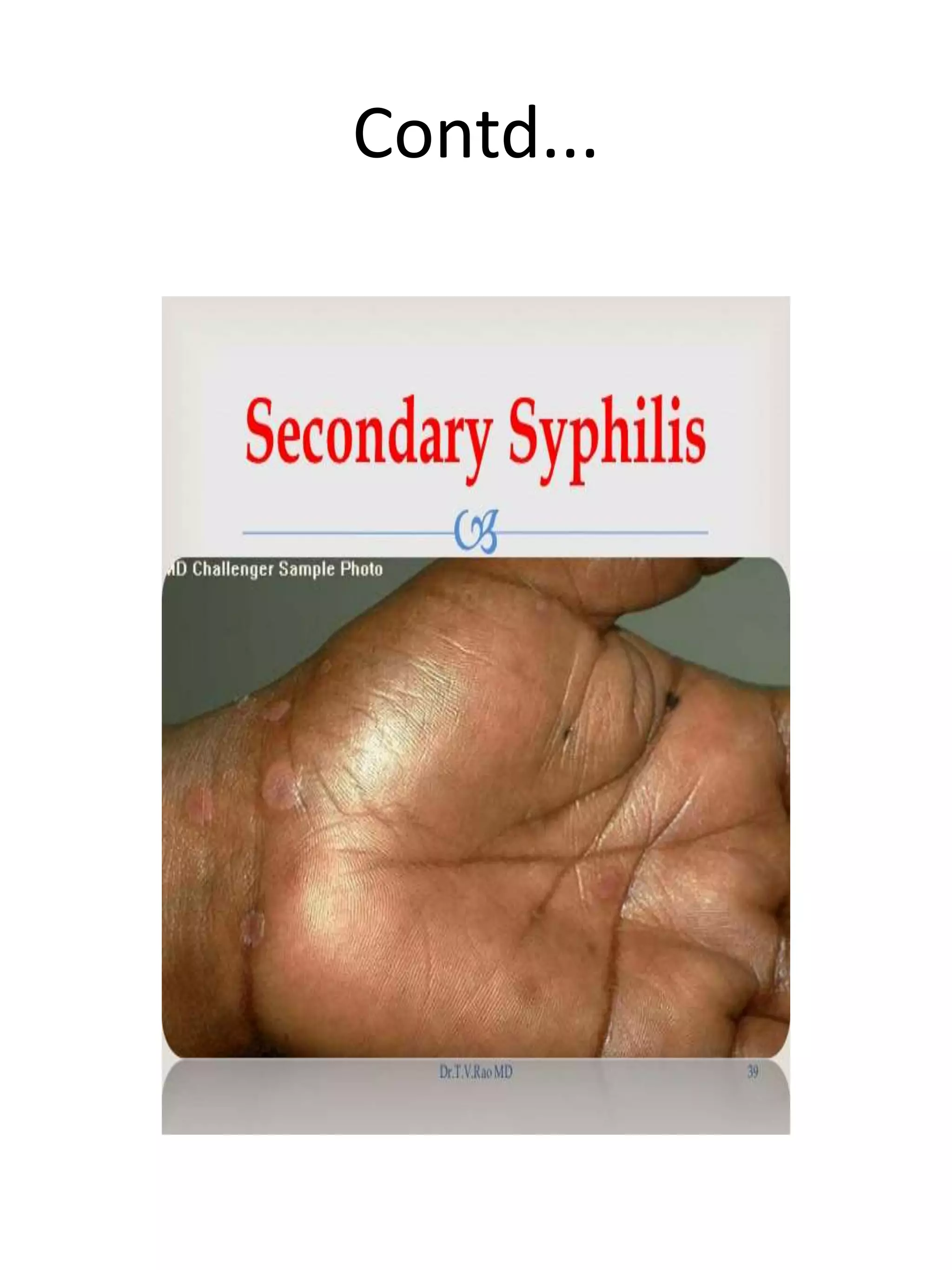Genital disease | PPTX