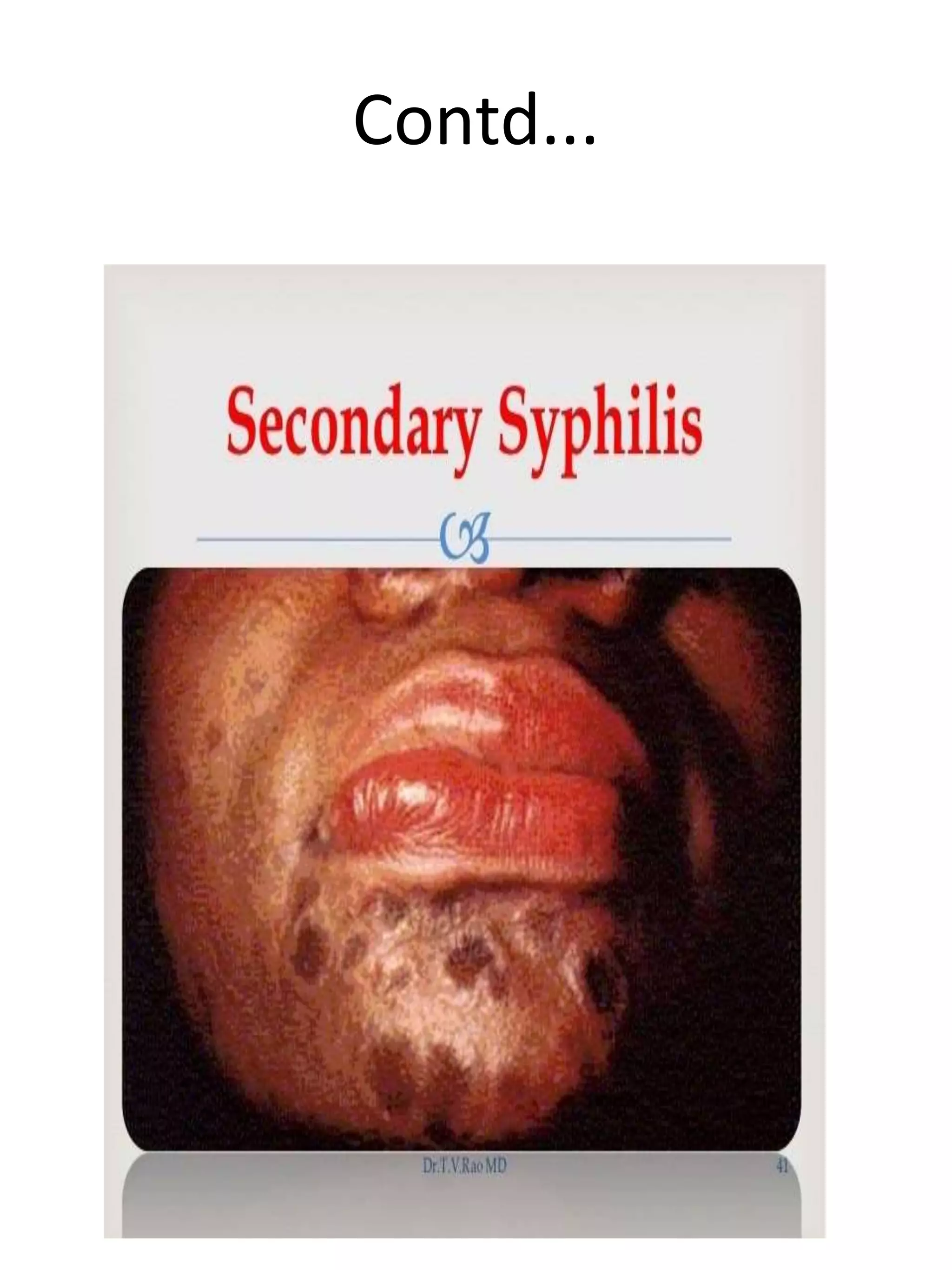 Genital disease | PPTX