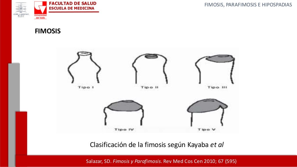 Fimosis y Parafimosis