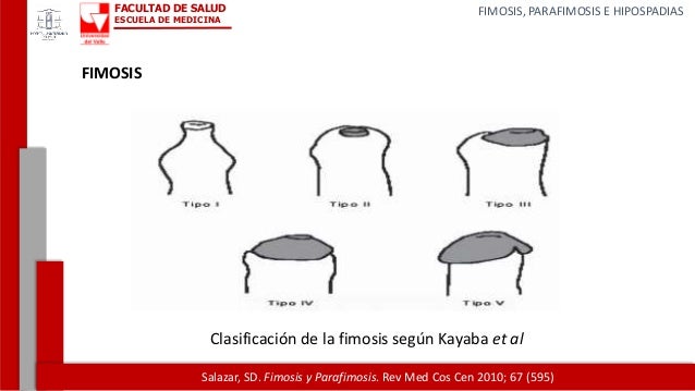 Fimosis Y Parafimosis