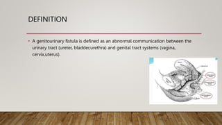 Genital fistula.pptx | Pregnancy | Reproductive Health