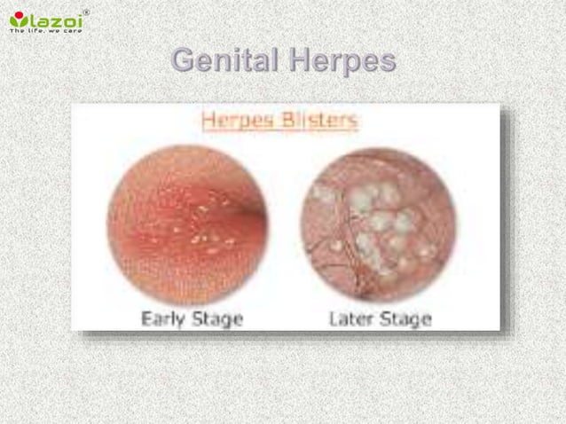 Genital herpes | PPTX | Infectious Diseases | Diseases and Conditions
