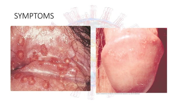 GENITAL HERPES.pptx STD , MEDICAL AND SURGICAL II | PPT