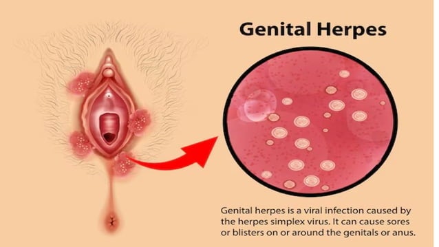 GENITAL HERPES.pptx STD , MEDICAL AND SURGICAL II | PPT