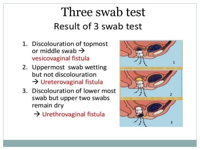 Genital tract fistula | PPTX | Sexual Conditions | Sexual Health