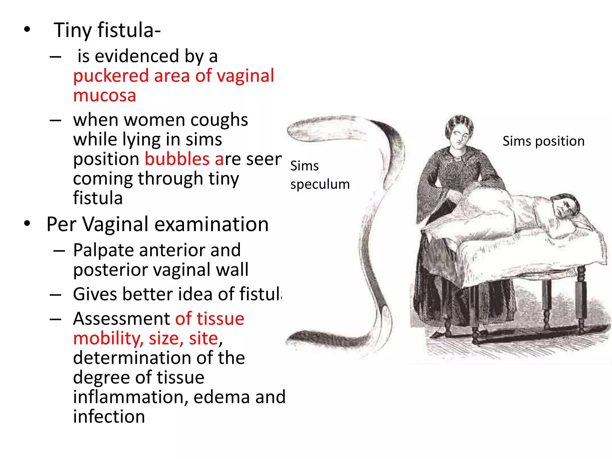 Genital tract fistulas main | PPTX