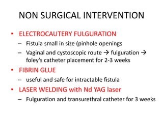 Genital tract fistulas main | PPTX