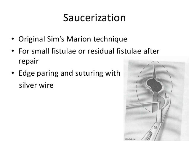 Genital tract fistulas main