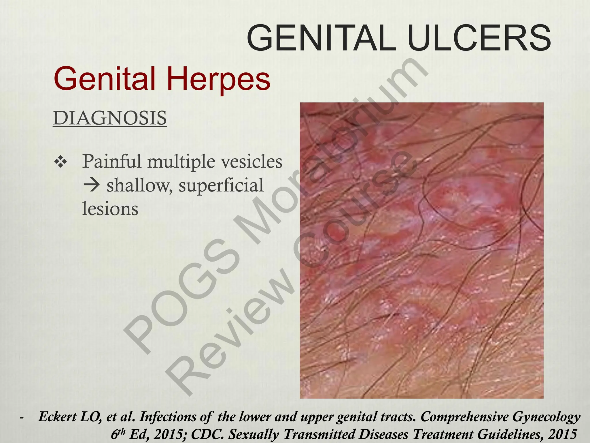 Genital Tract Infections of upper and lower reproductive organ | PPT