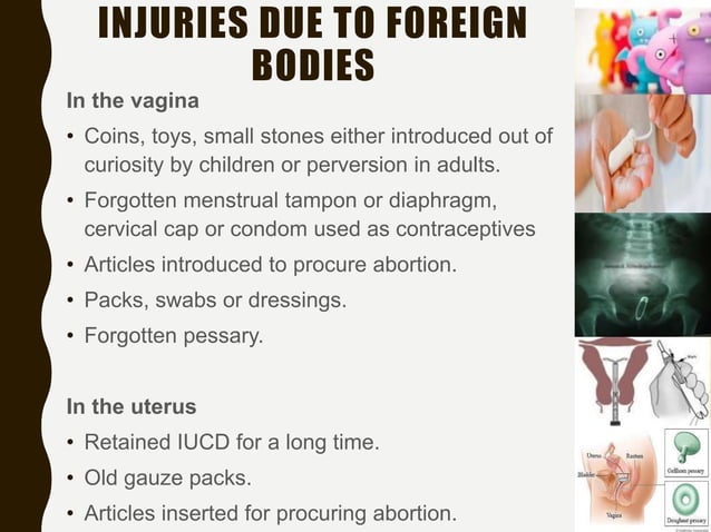 Genital tract injuries1 | PPTX