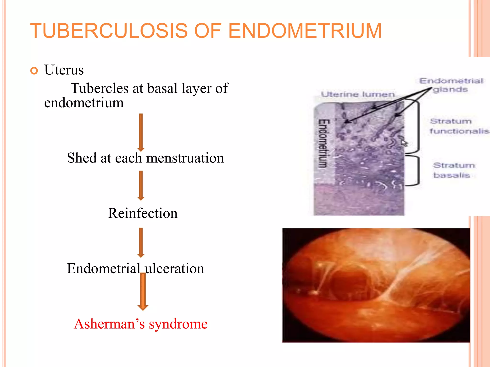 Genital tuberculosis | PPTX