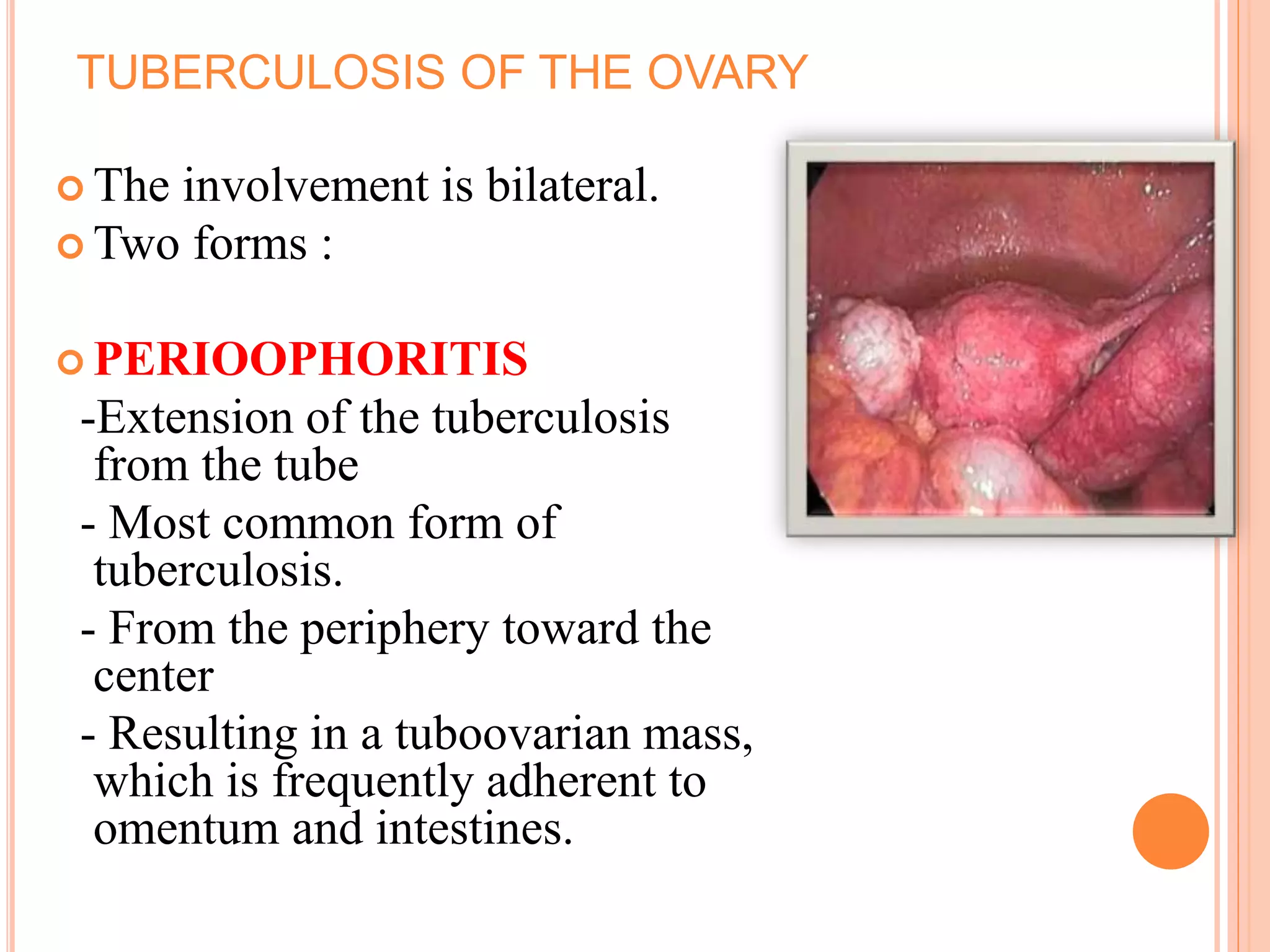 Genital tuberculosis | PPTX