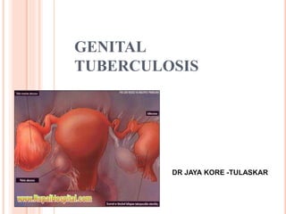 Genital tuberculosis | PPTX